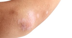 ¿Codos Secos y Rugosos?